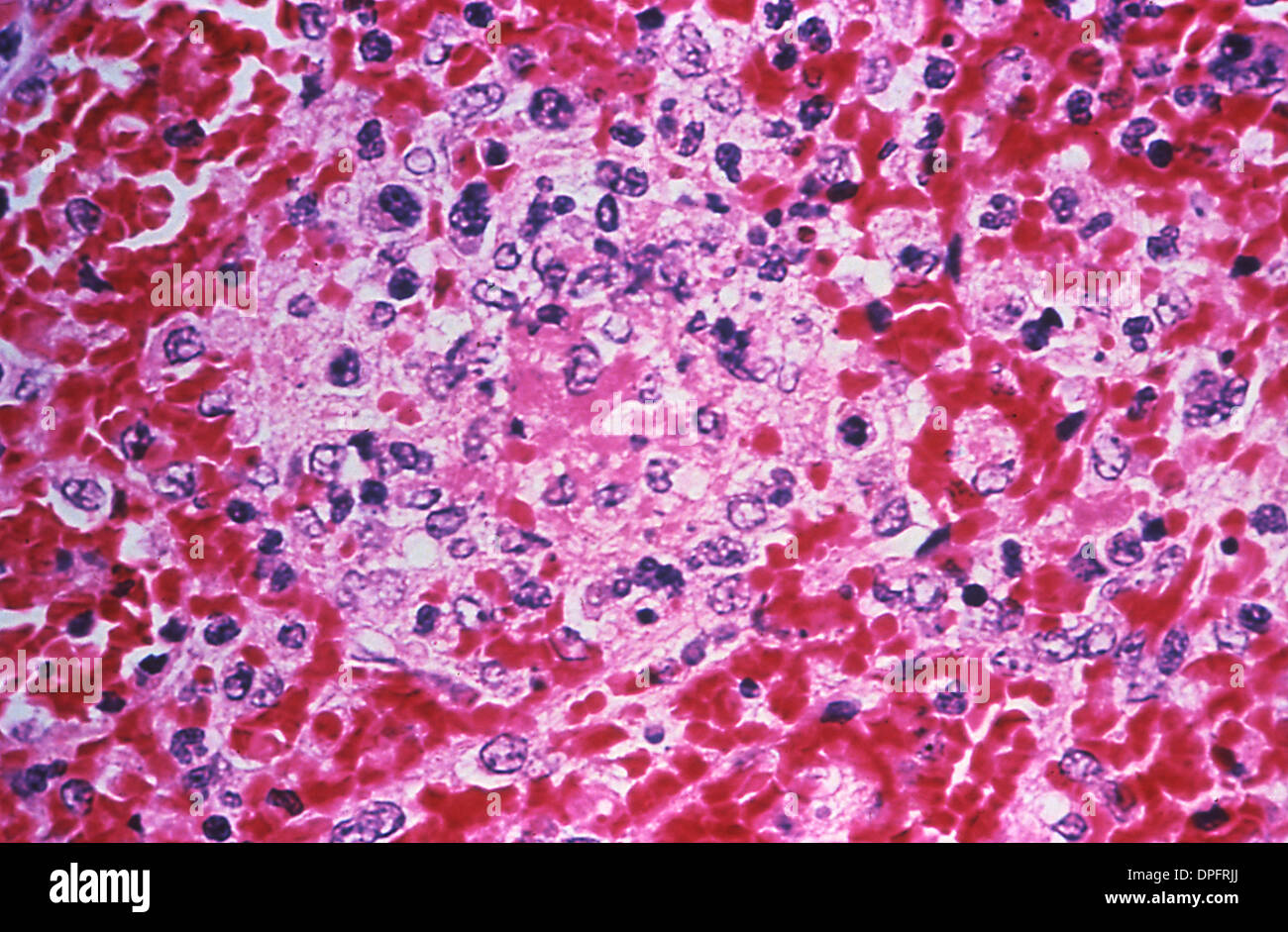 splenic tissue in a case of fatal human plague Stock Photo - Alamy