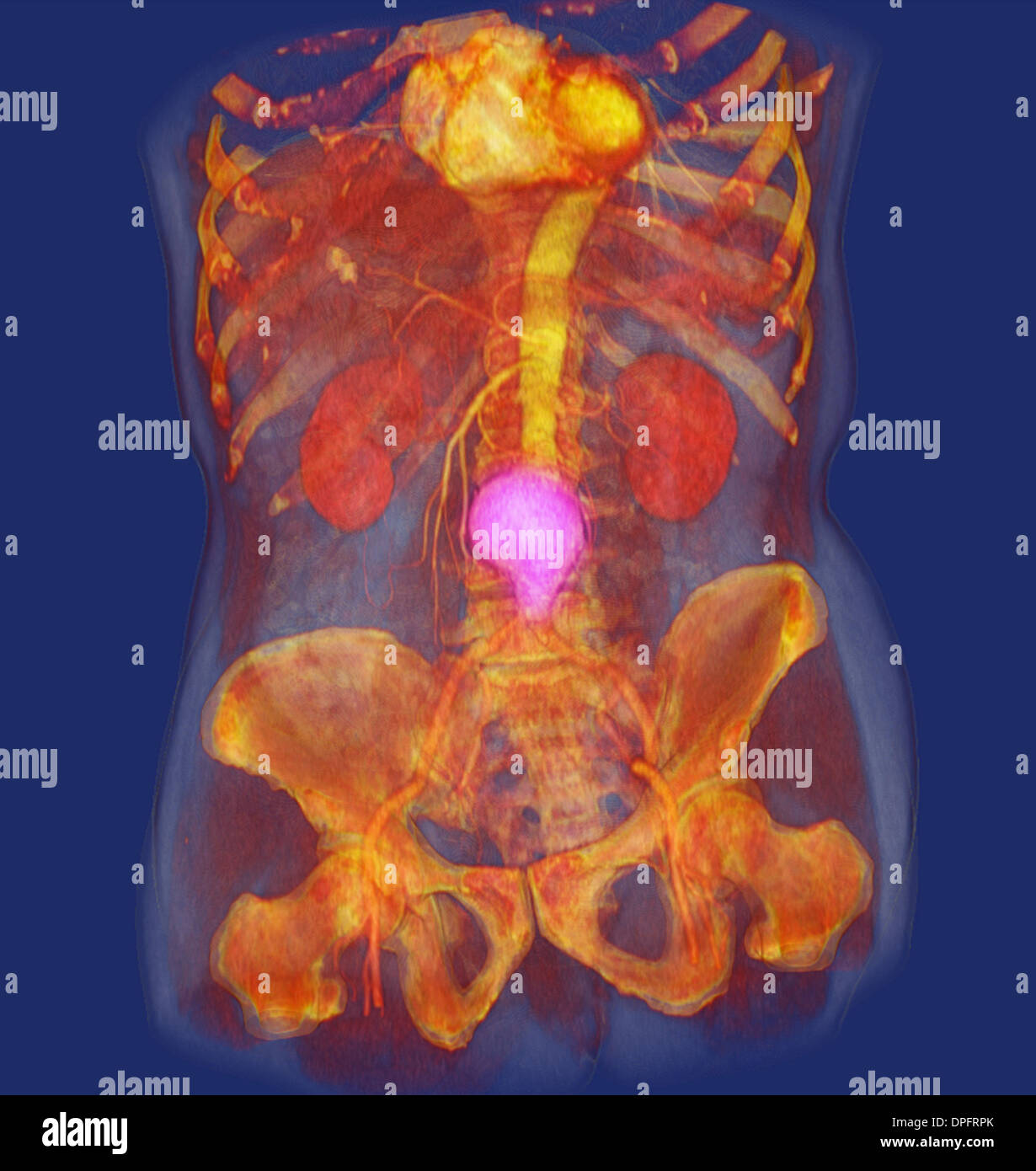 Abdominal aortic aneurysm hi-res stock photography and images - Alamy