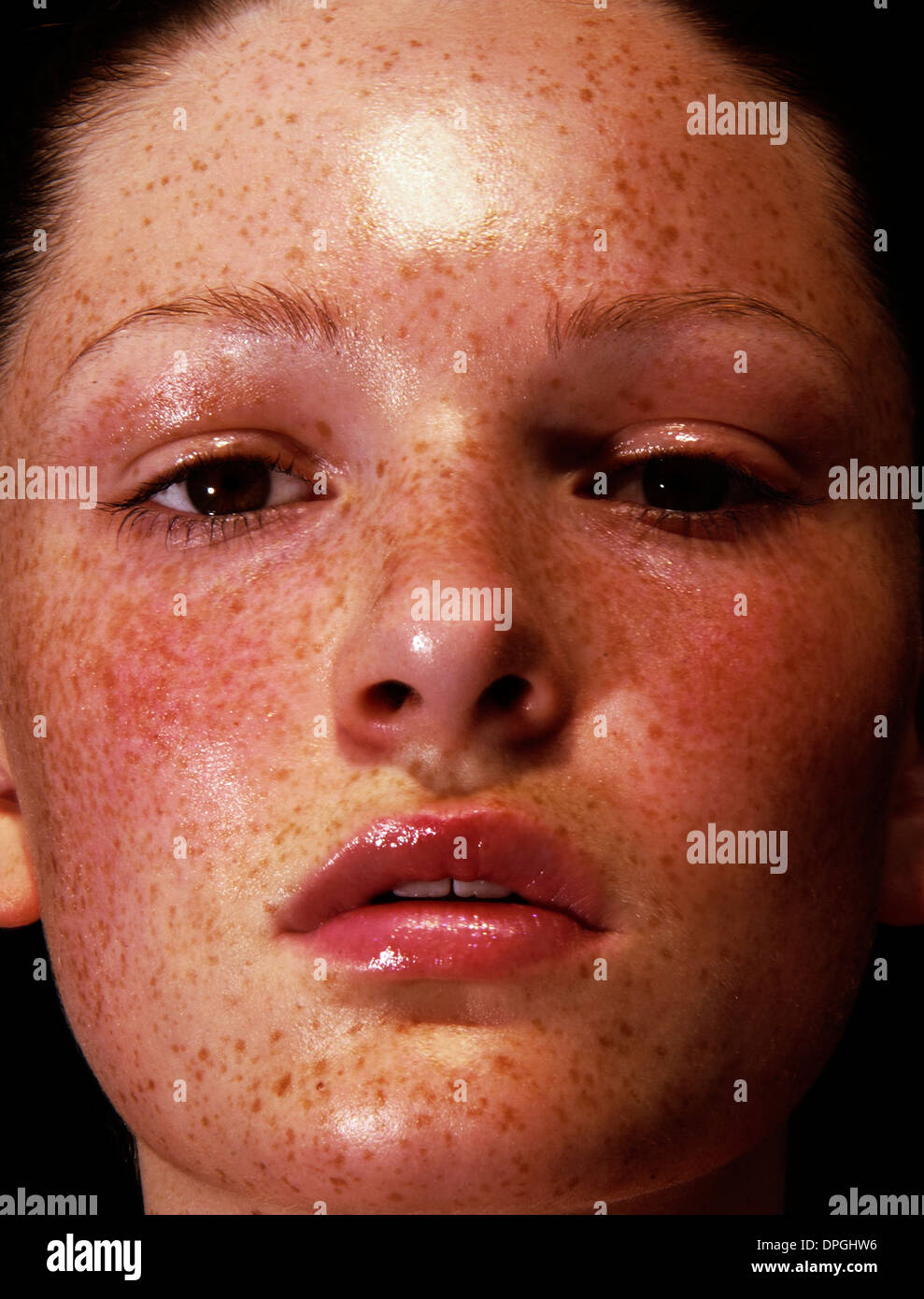 Sun damage freckles hi-res stock photography and images - Alamy
