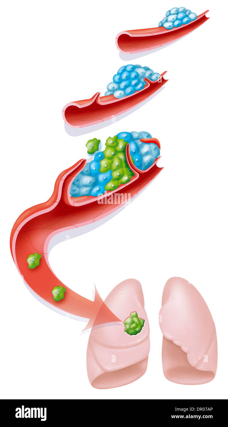 Lung Cancer Drawing High Resolution Stock Photography and Images - Alamy