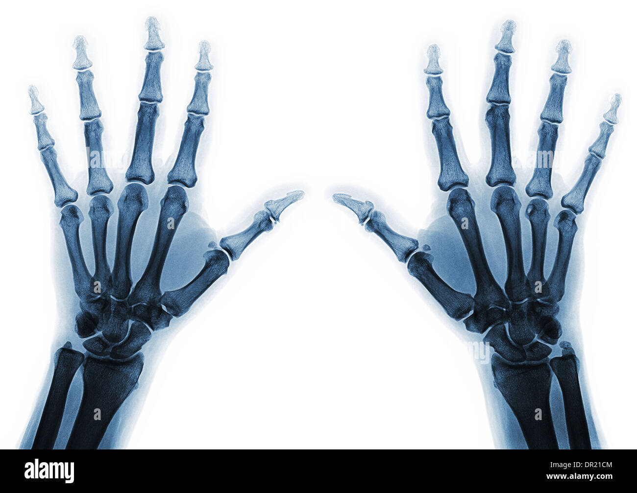 Fractured finger x ray Cut Out Stock Images & Pictures - Alamy