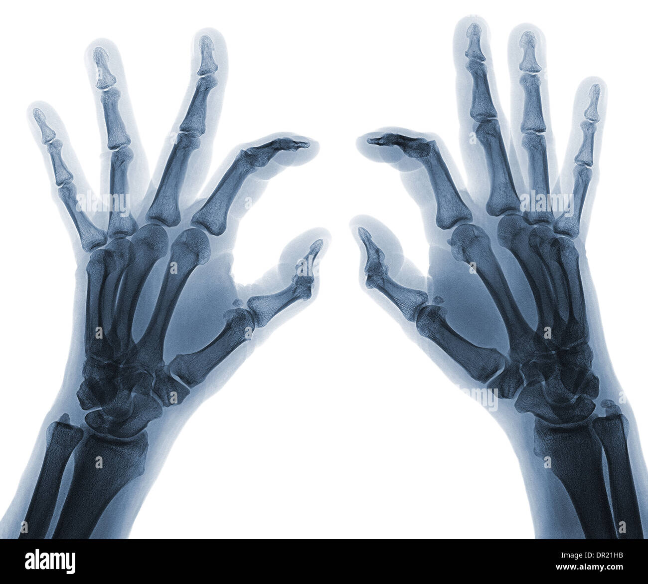 X-rays of hands of an adult man with visible damage Stock Photo - Alamy