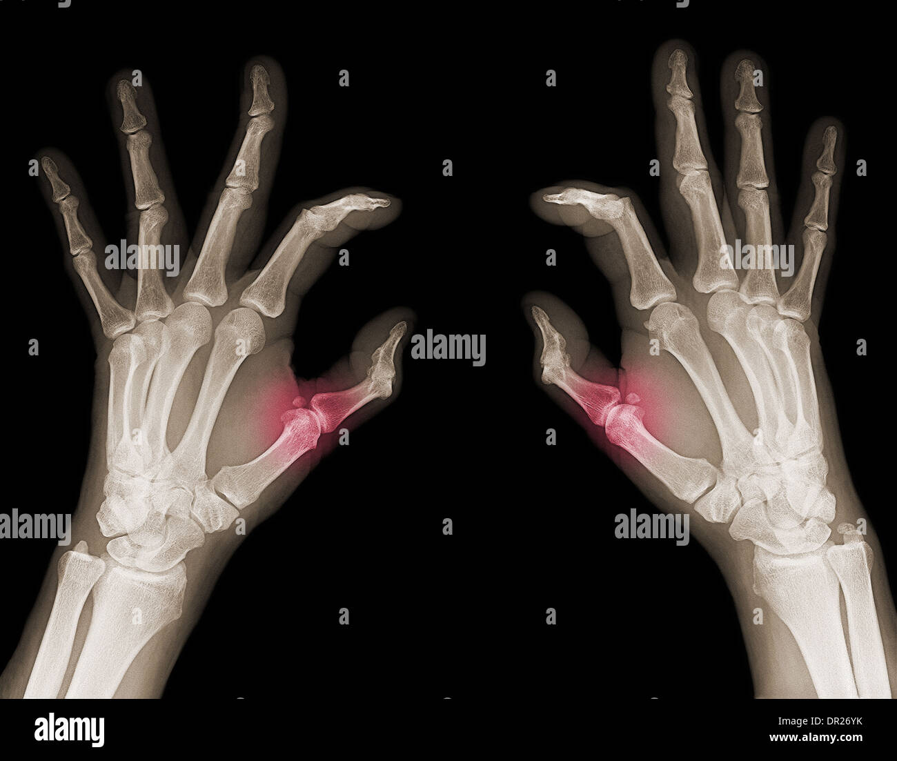 X-rays of hands of an adult man with visible damage Stock Photo - Alamy