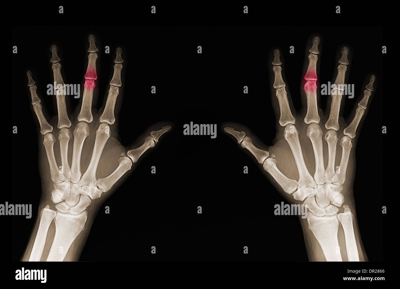 X-rays of hands of an adult man with visible damage Stock Photo - Alamy