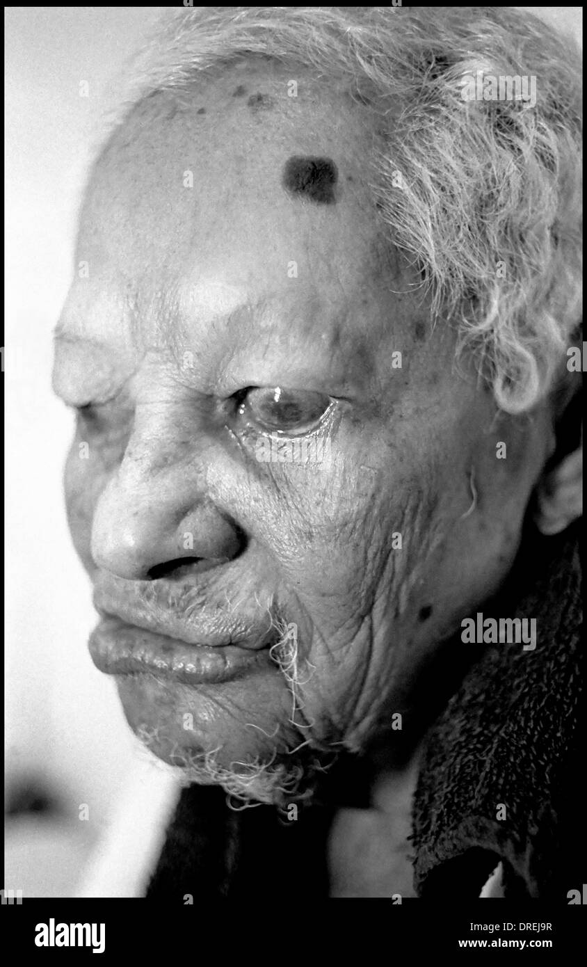 Hansens Disease Patients High Resolution Stock Photography and Images ...