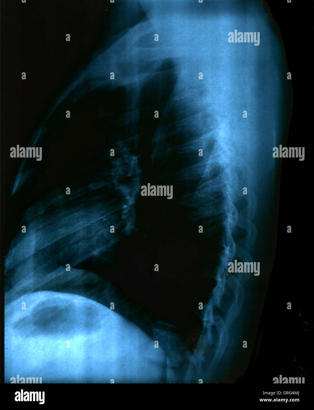 X Ray Image Of Human Healthy Chest Stock Photo - Alamy
