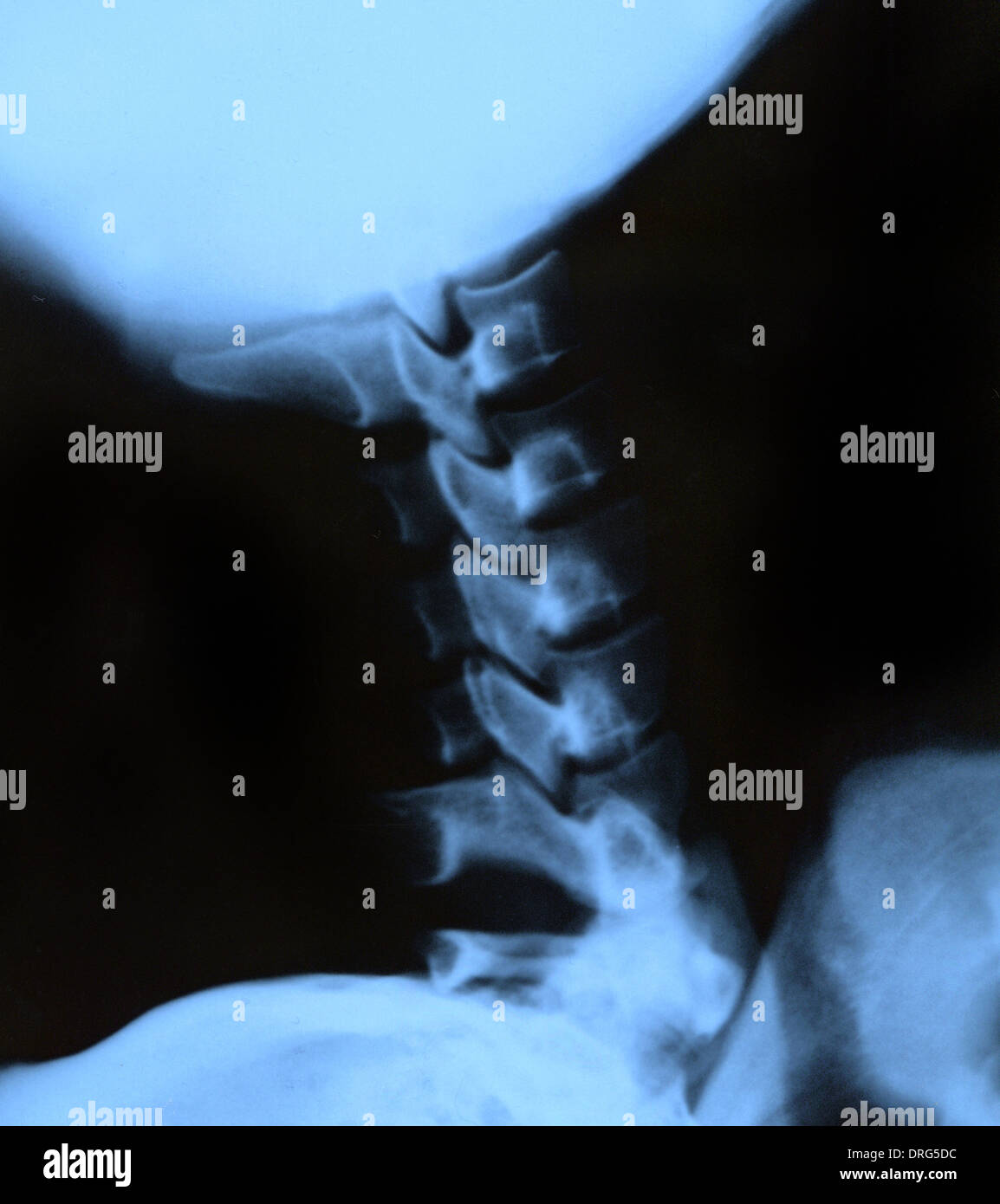Scan of x-ray of the neck, cervical area Stock Photo - Alamy