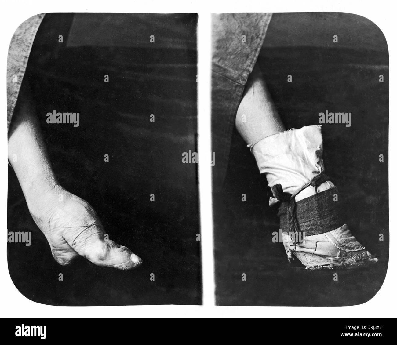 Bound foot Black and White Stock Photos & Images - Alamy