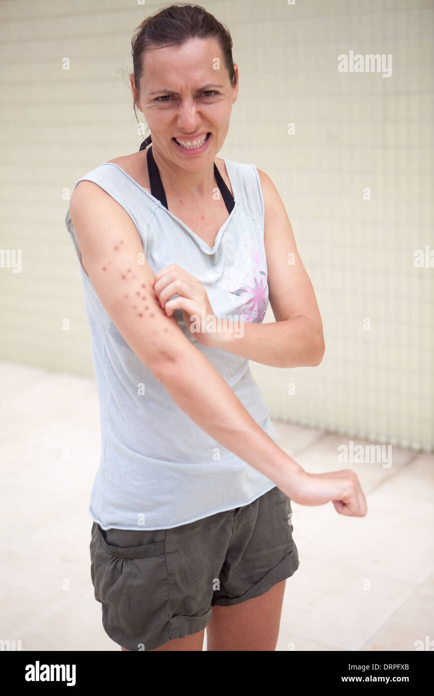 Woman scratching arm Stock Photo - Alamy