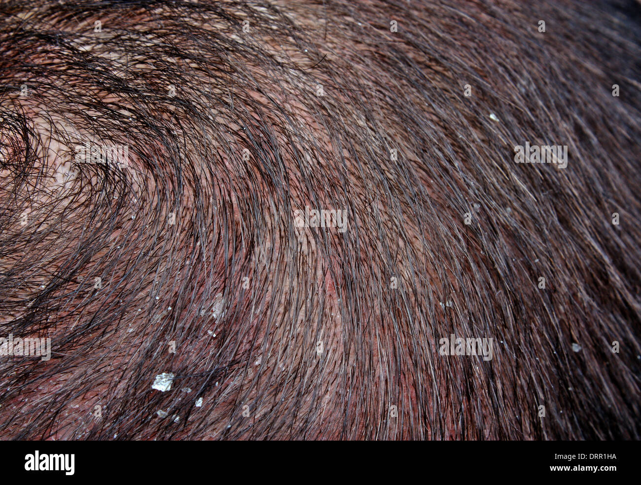 Dandruff in the hair of a man Stock Photo - Alamy