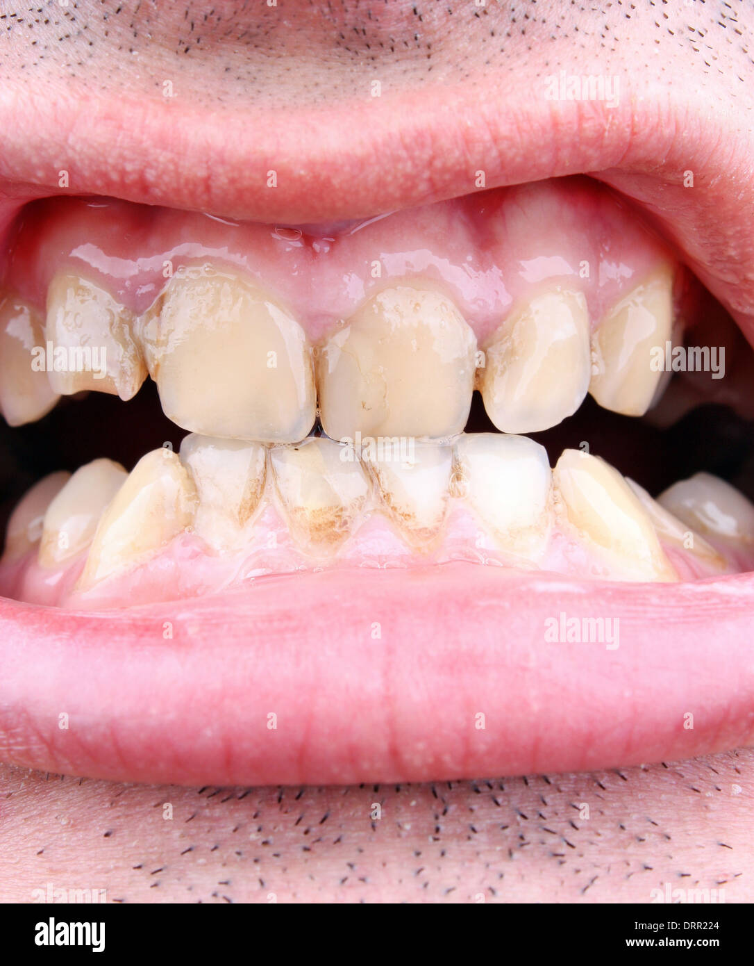 Diseased teeth of the patient. Tartar and tooth decay Stock Photo - Alamy