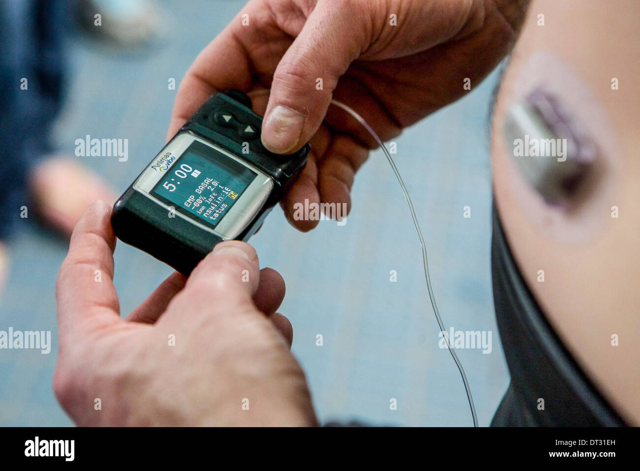 Insulin pump hi-res stock photography and images - Alamy