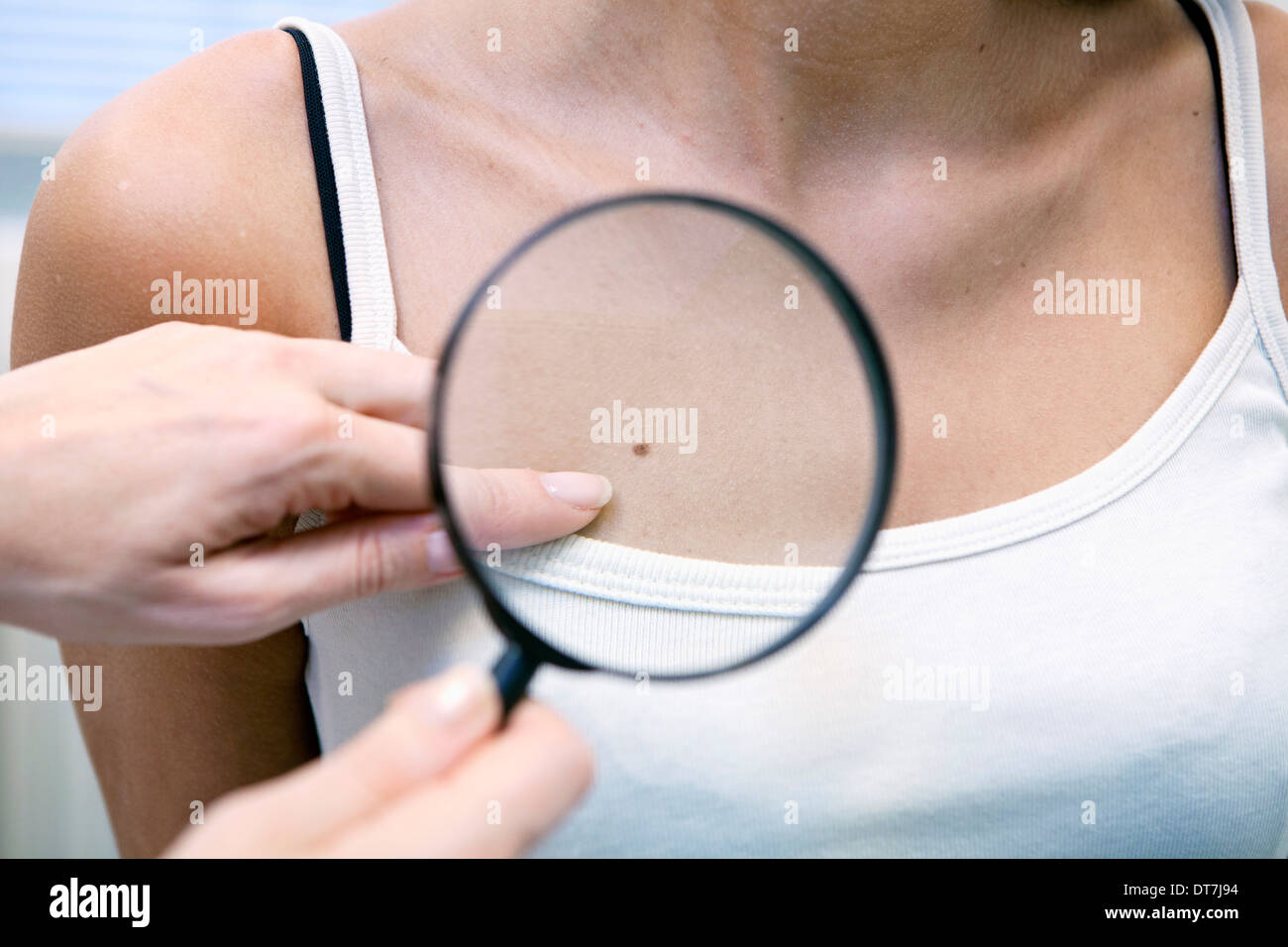 DERMATOLOGY, SYMPTOMATOLOGY, WOMAN Stock Photo - Alamy