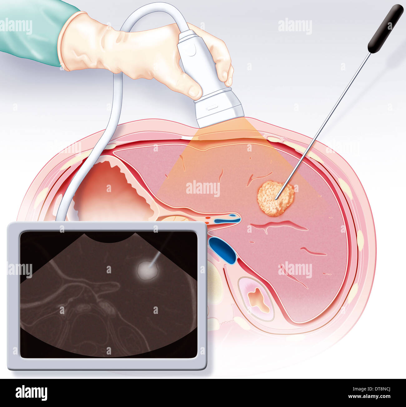 Radiofrequency ablation liver hi-res stock photography and images - Alamy