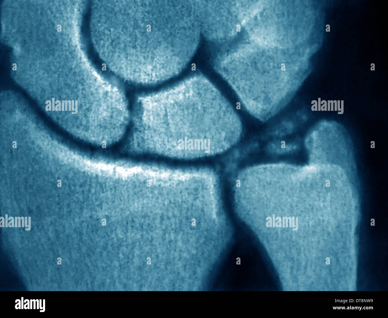 Chondrocalcinosis High Resolution Stock Photography and Images - Alamy