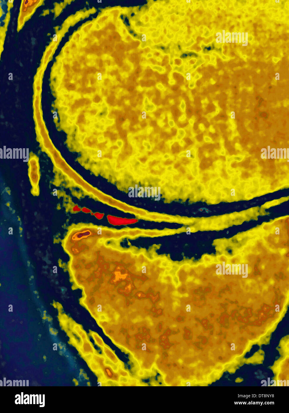 DAMAGED MENISCUS, MRI Stock Photo - Alamy