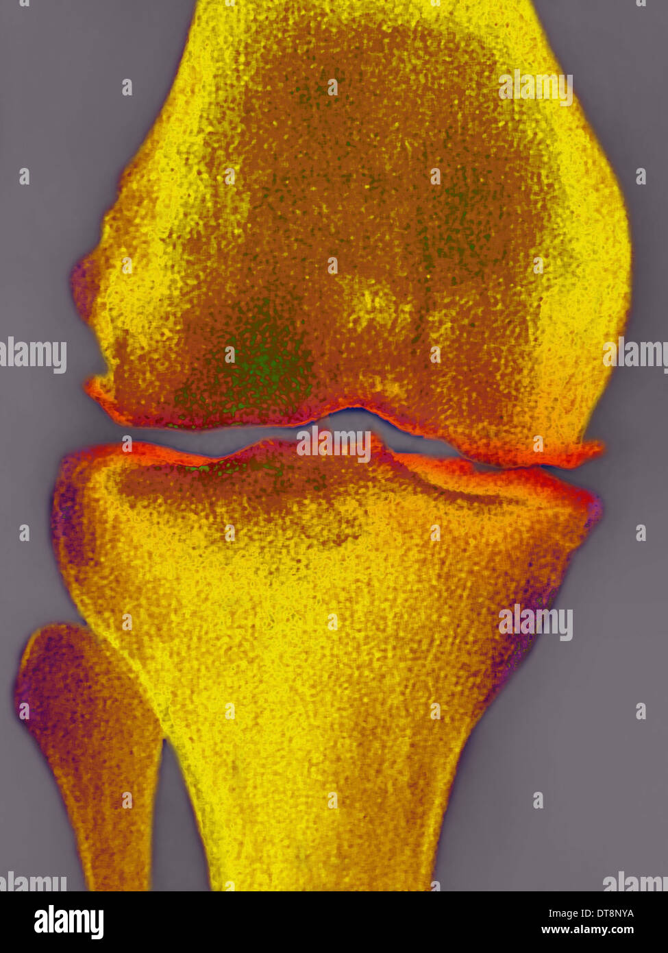 Gonarthrosis High Resolution Stock Photography and Images - Alamy