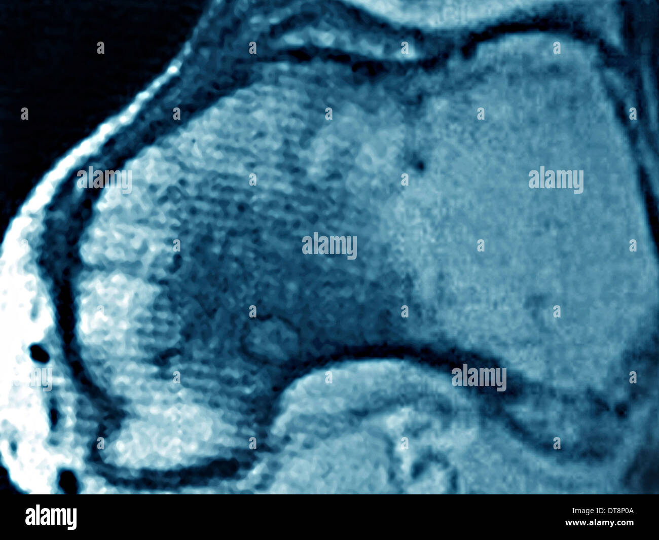 OSTEOID OSTEOMA MRI Stock Photo: 66575722 - Alamy