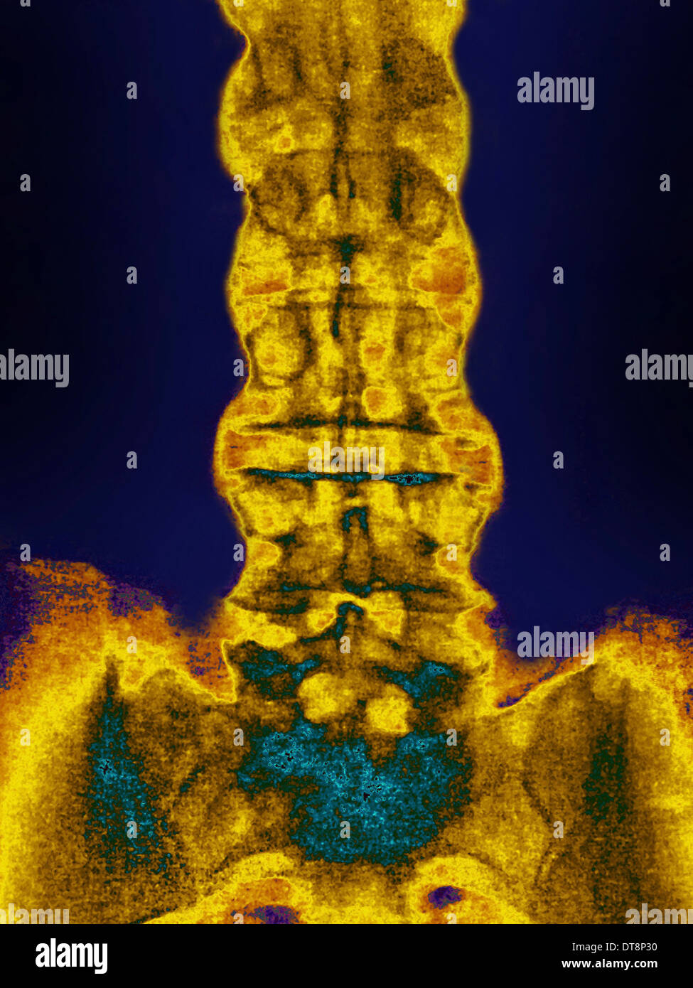 Ankylosing Spondylitis High Resolution Stock Photography and Images - Alamy