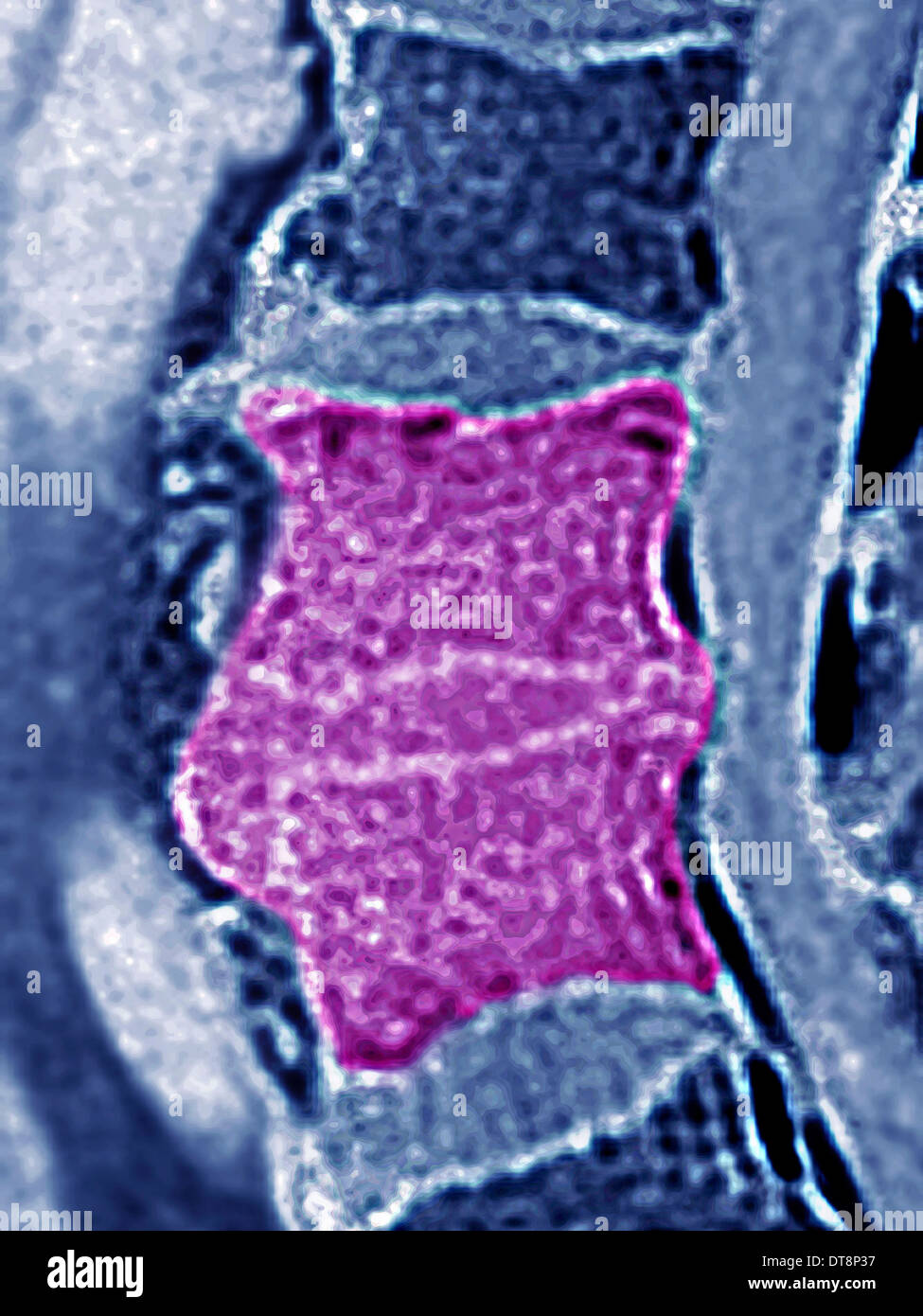 Spondylodiscitis mri hi-res stock photography and images - Alamy