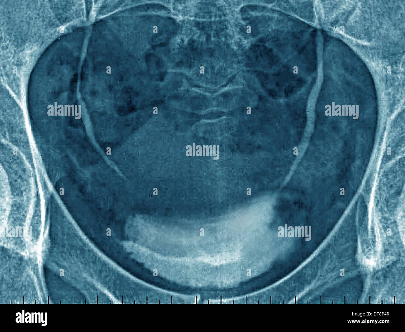 BENIGN TUMOR OF THE BLADDER Stock Photo - Alamy