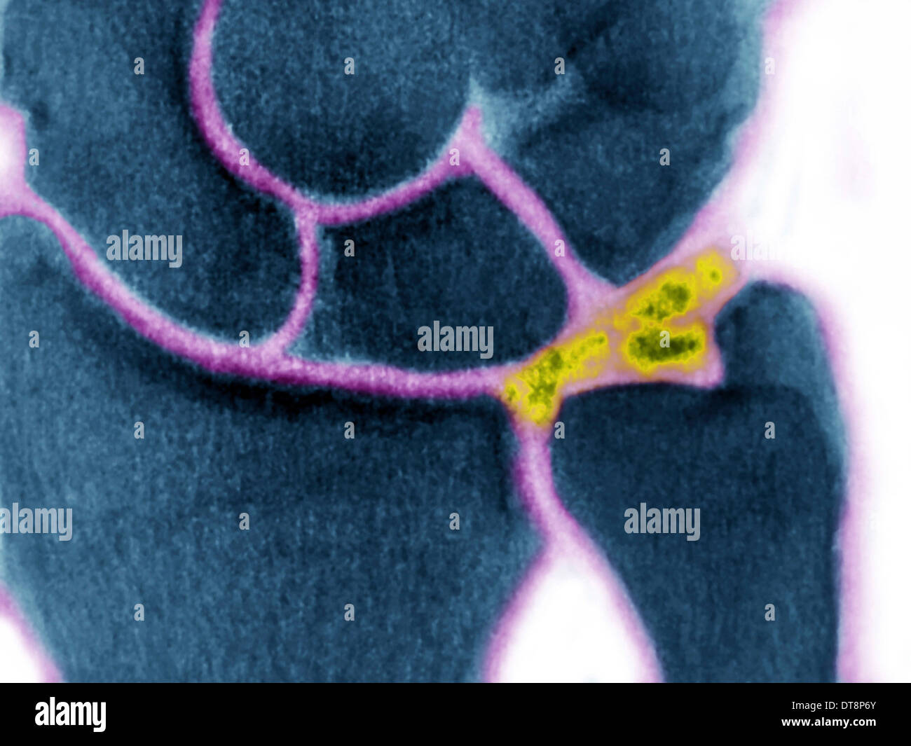 X ray of articular cartilage hi-res stock photography and images - Alamy
