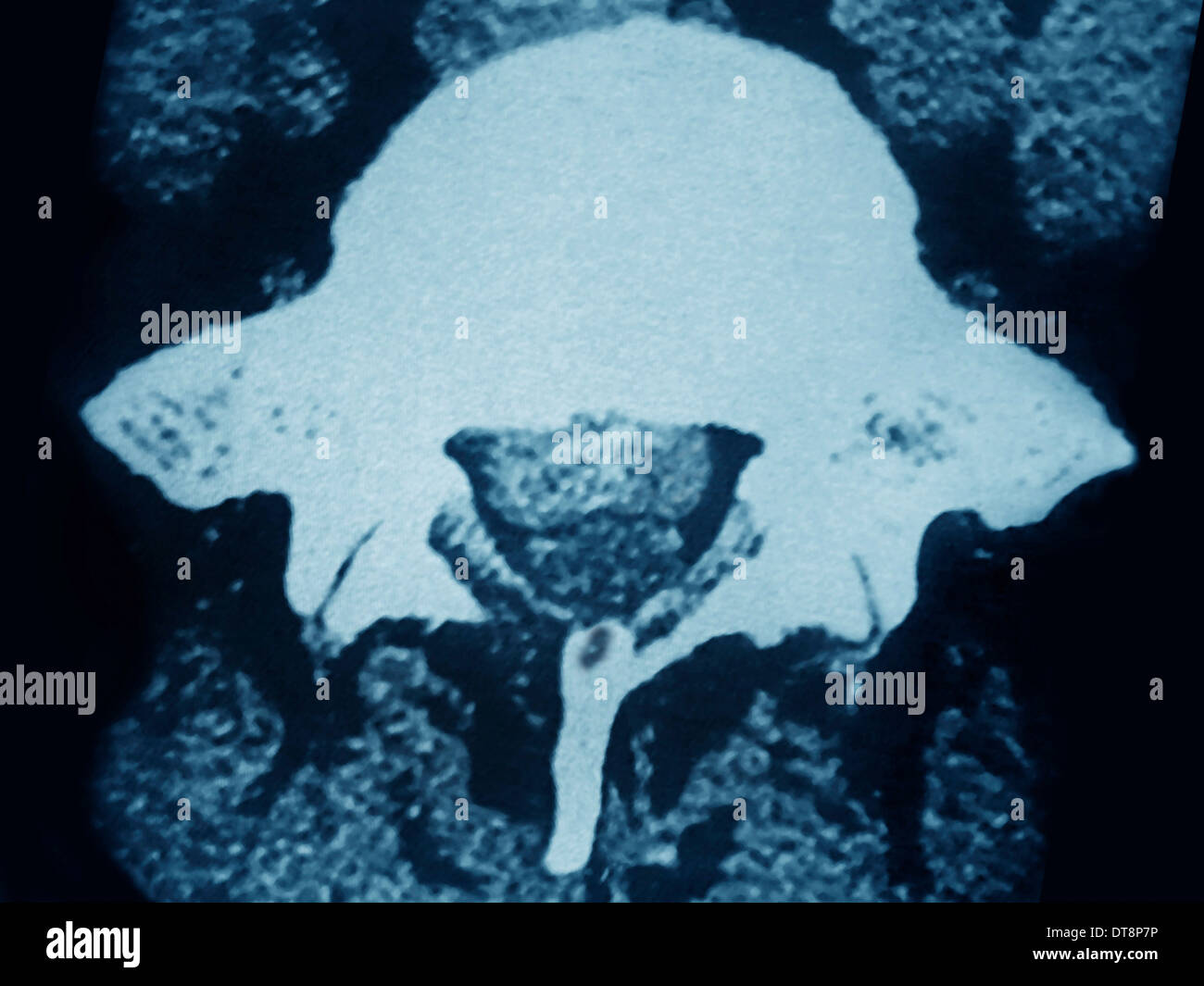 HERNIATED DISK, CT SCAN Stock Photo - Alamy