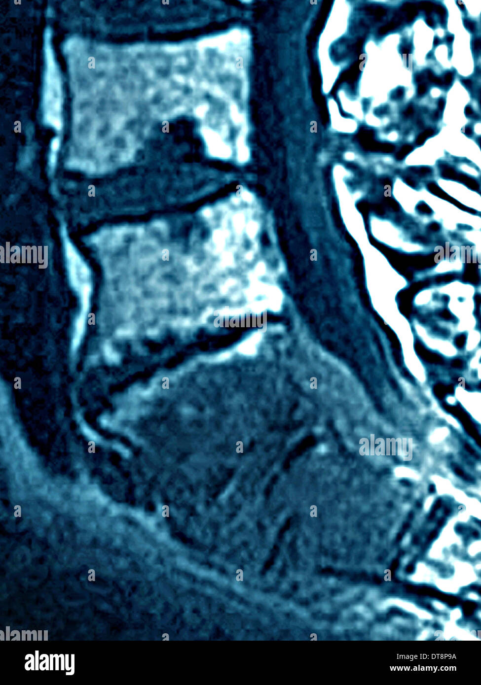 Osteitis hi-res stock photography and images - Alamy