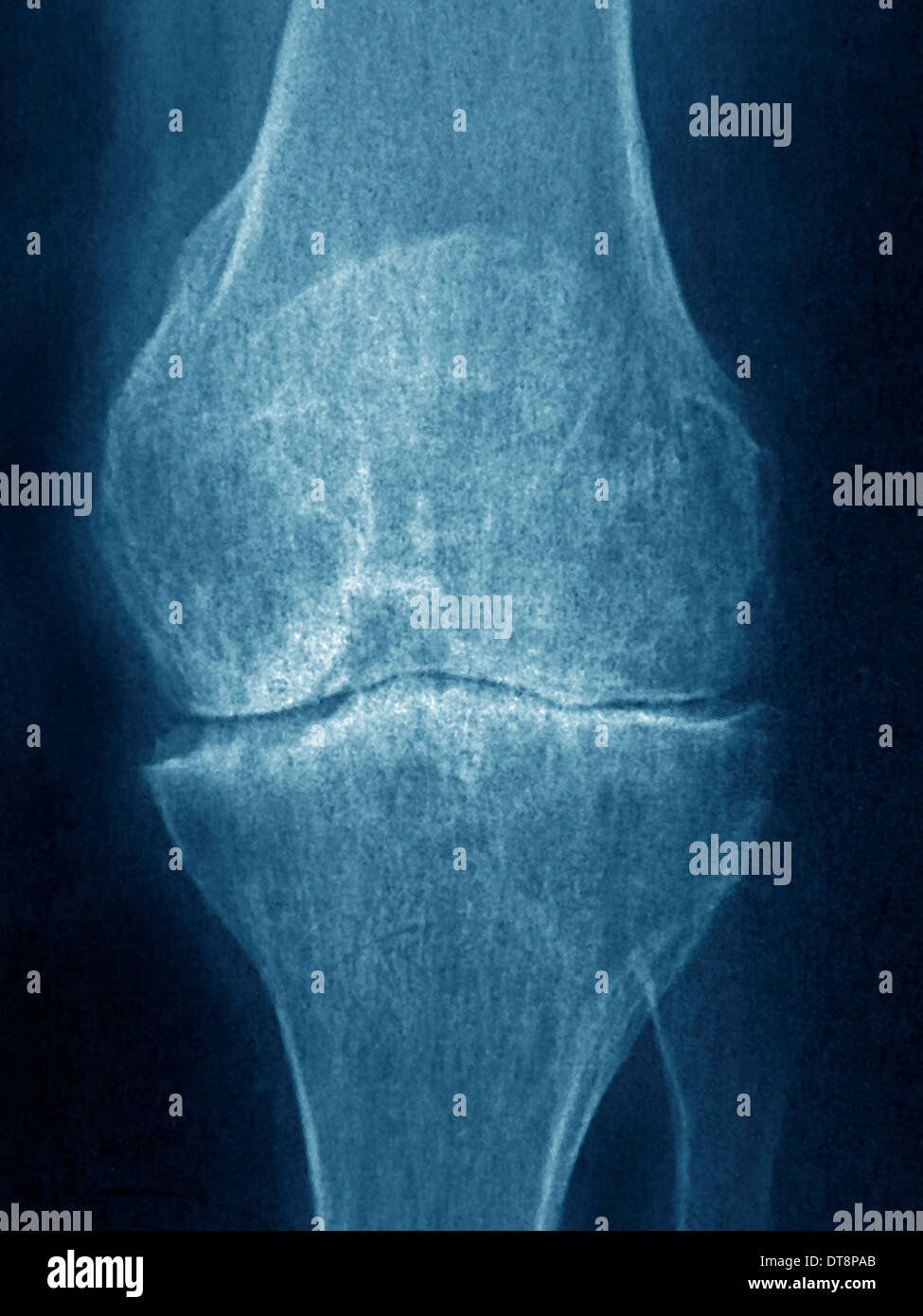 Arthritis knee x ray hi-res stock photography and images - Alamy