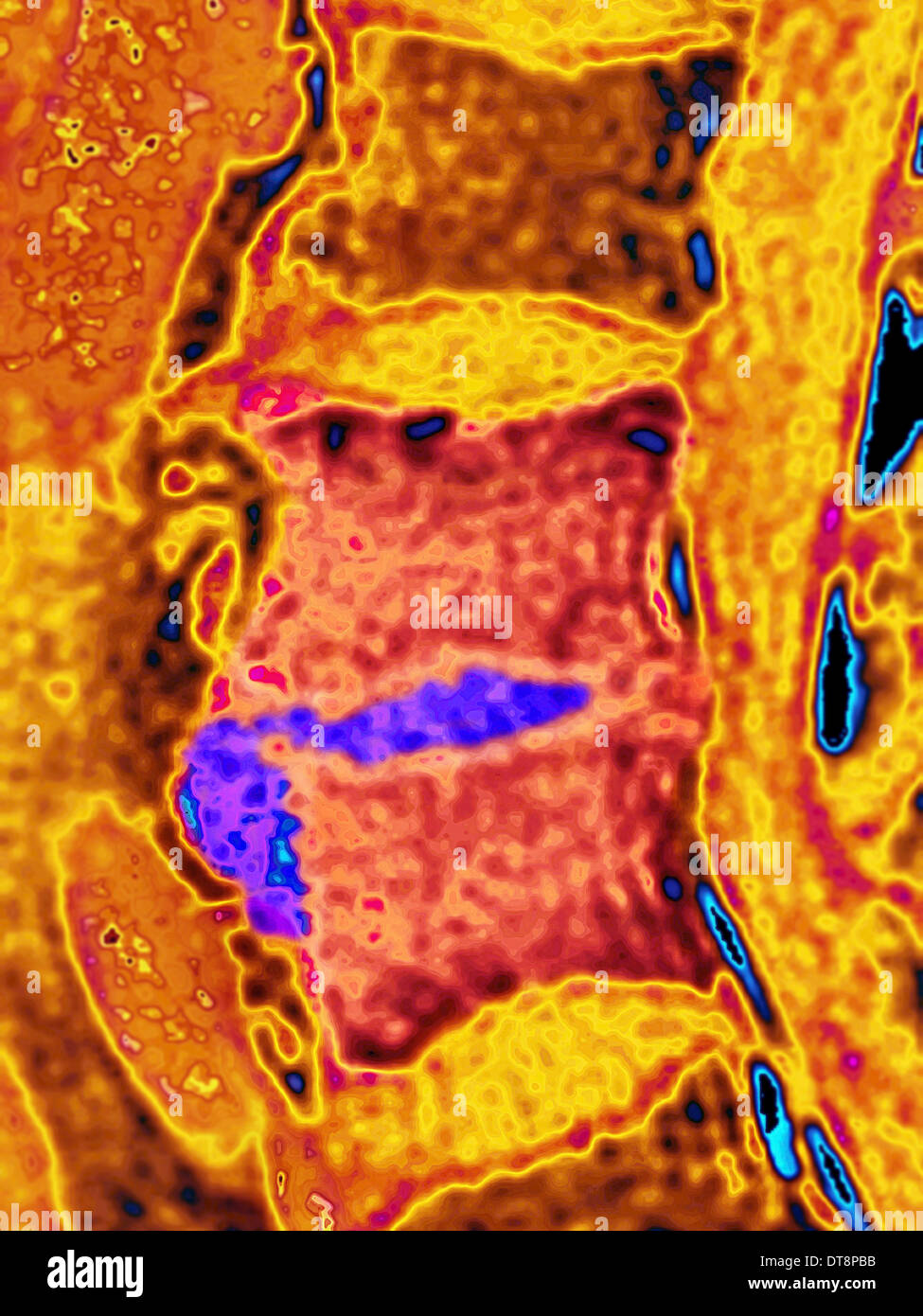 Spondylodiscitis mri hi-res stock photography and images - Alamy