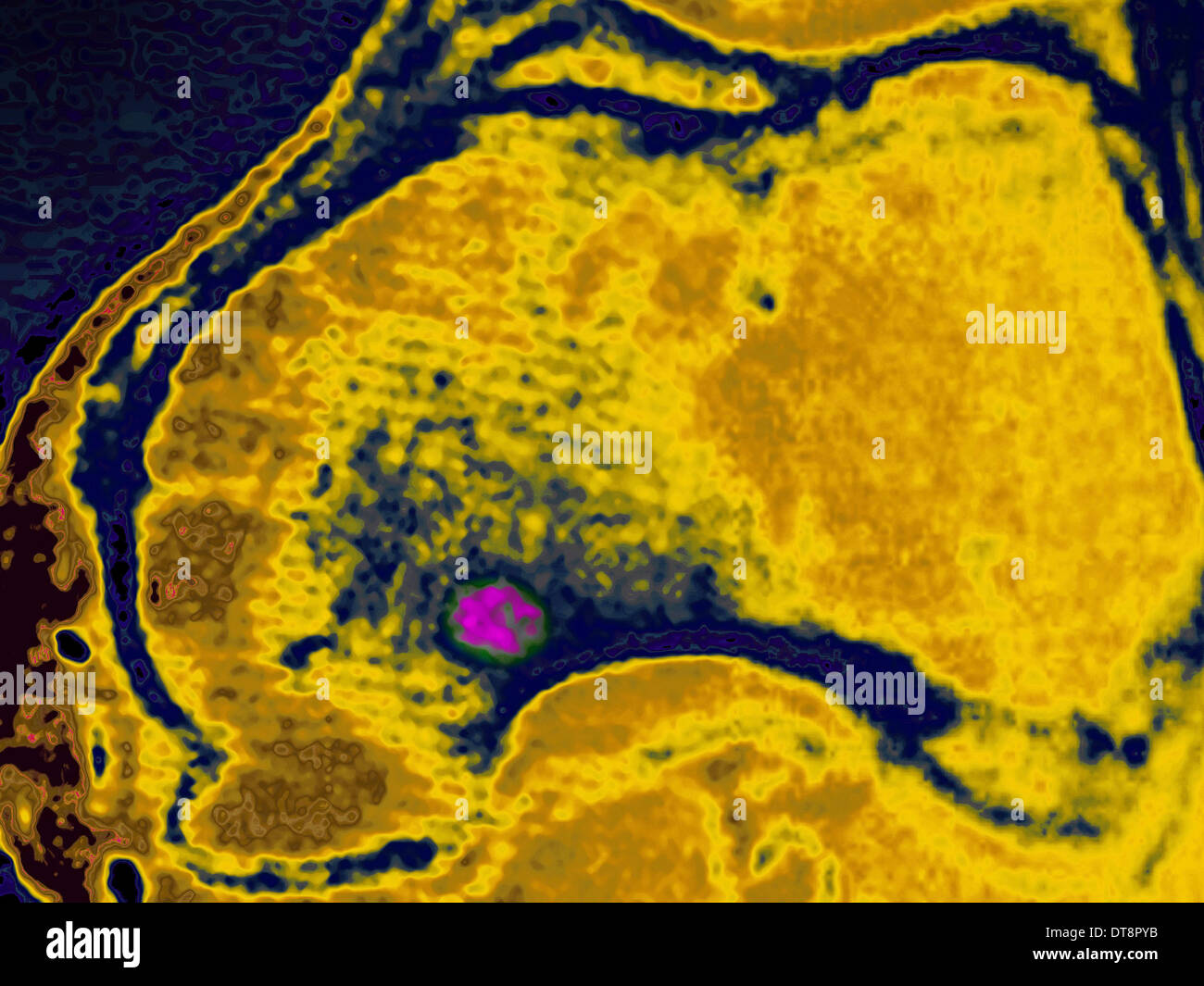 OSTEOID OSTEOMA MRI Stock Photo - Alamy