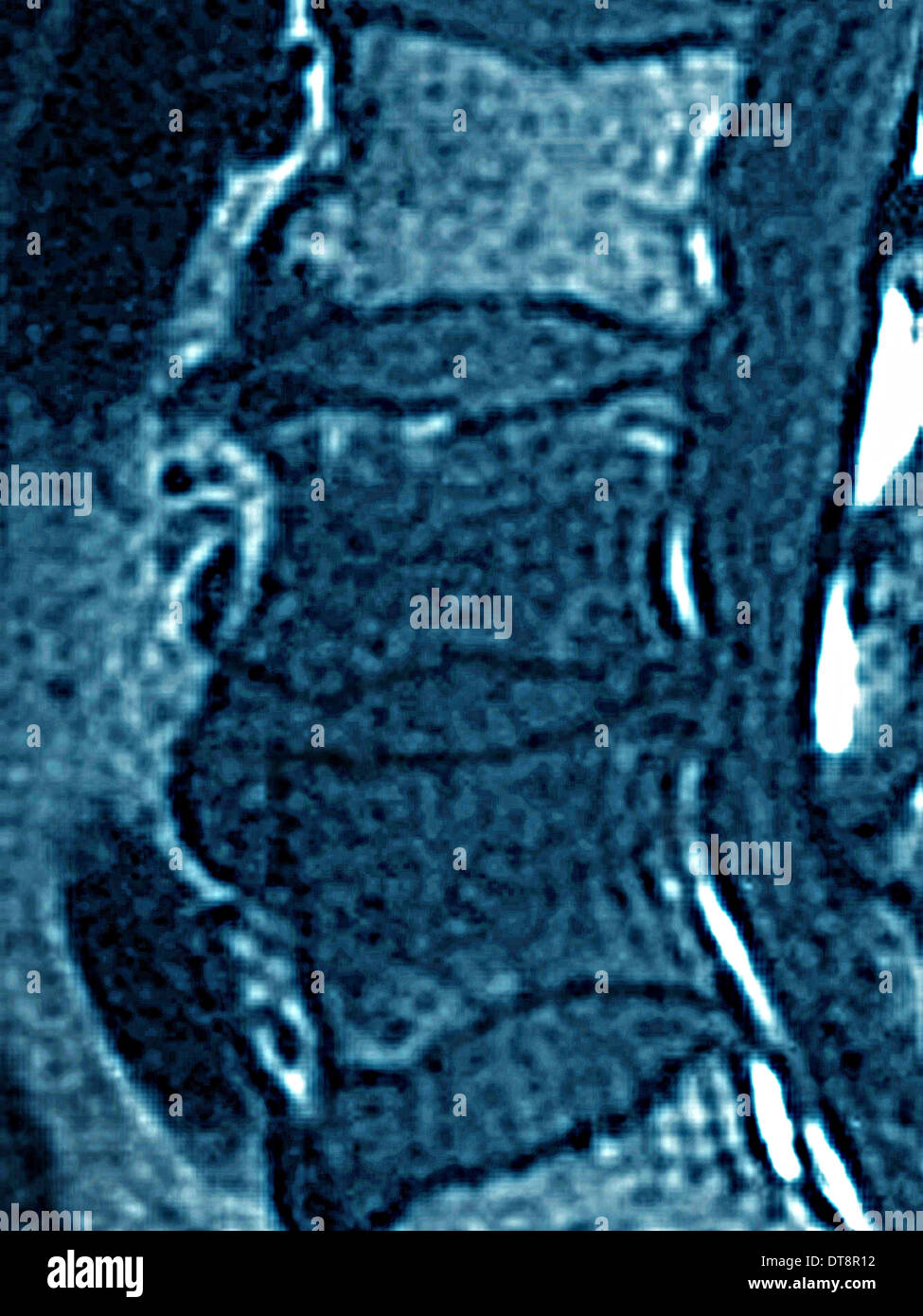 Vertebral Disc Stock Photos & Vertebral Disc Stock Images - Alamy