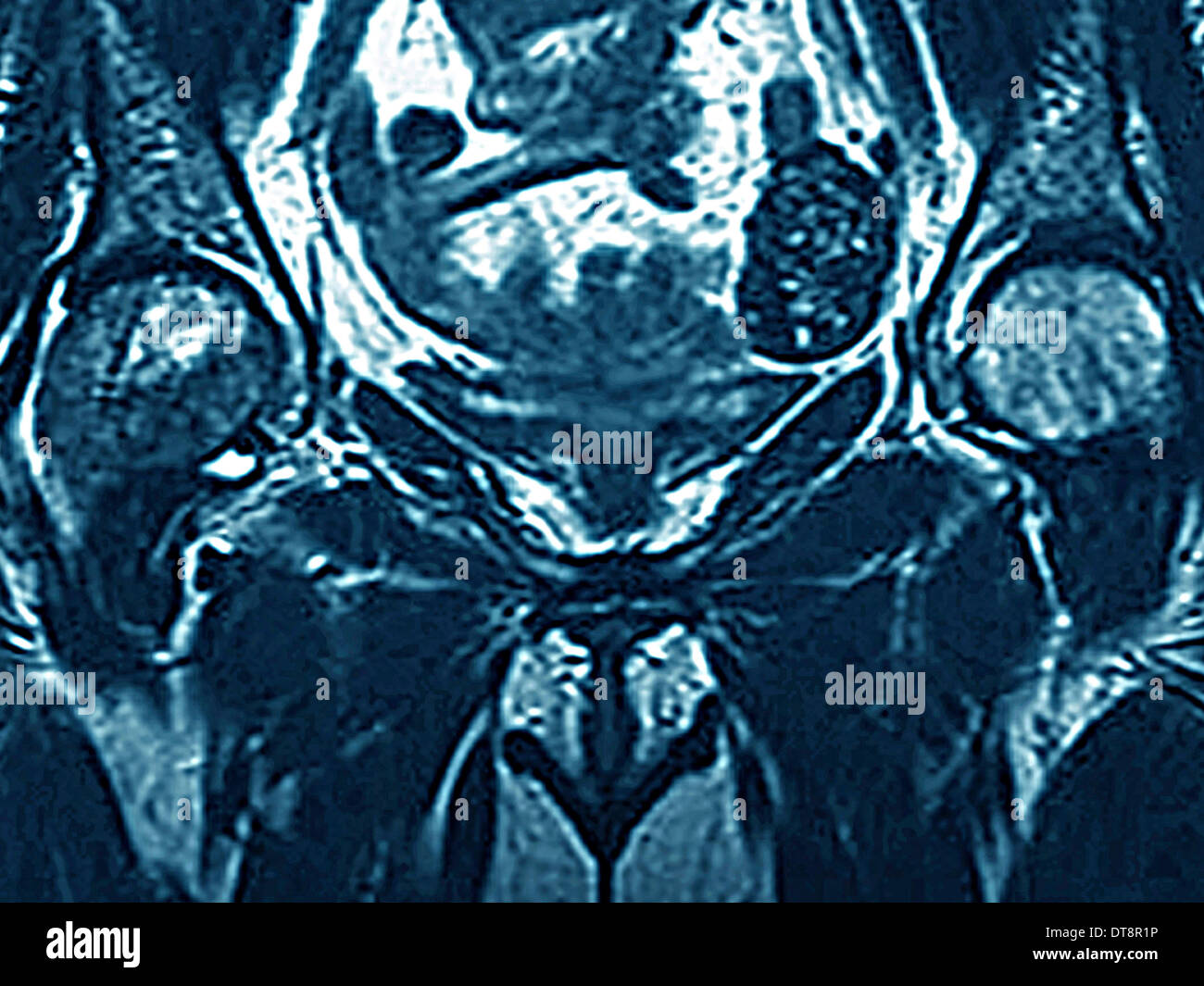 BONE METASTASIS, MRI Stock Photo - Alamy