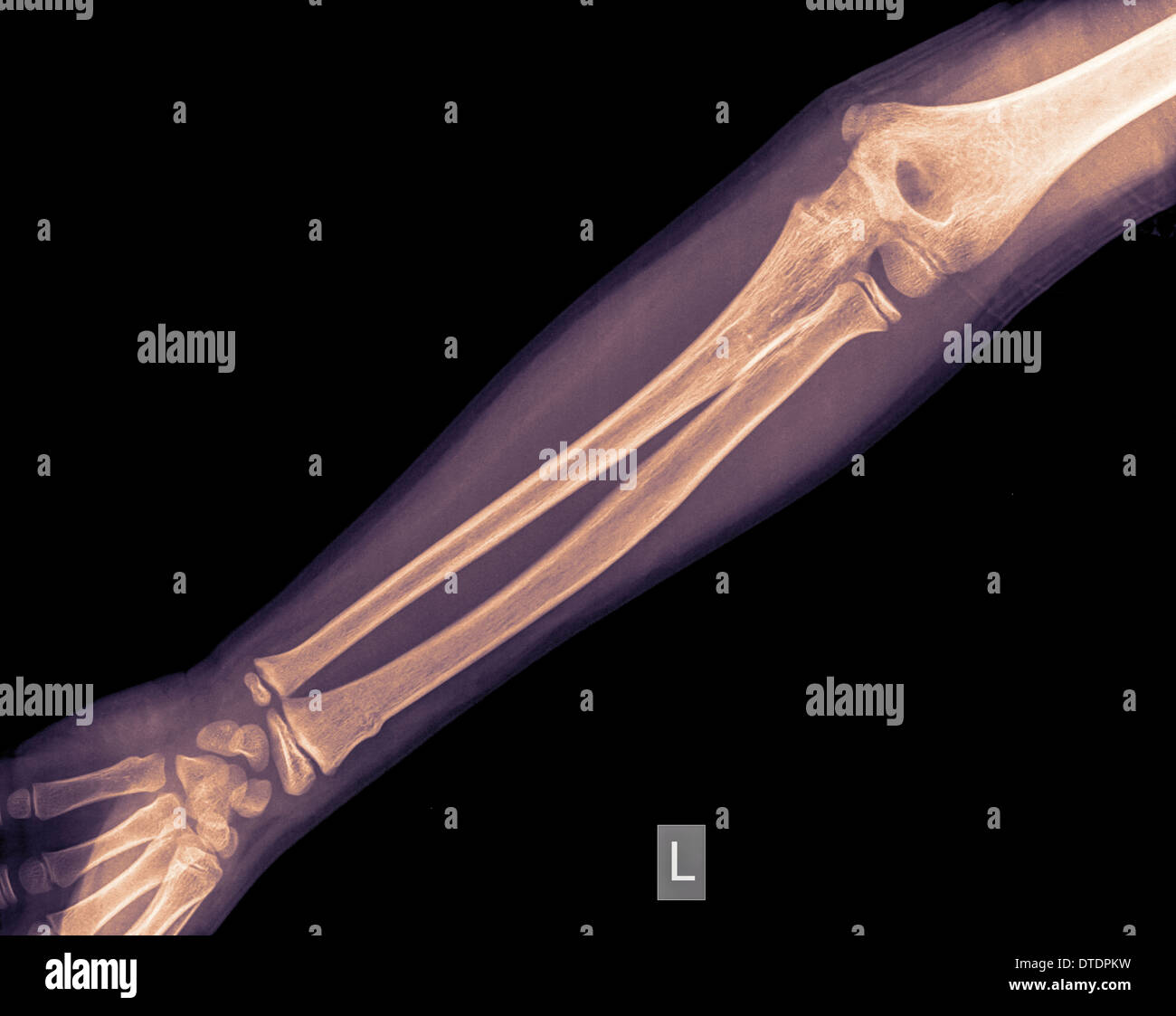 Distal radius fracture hi-res stock photography and images - Alamy