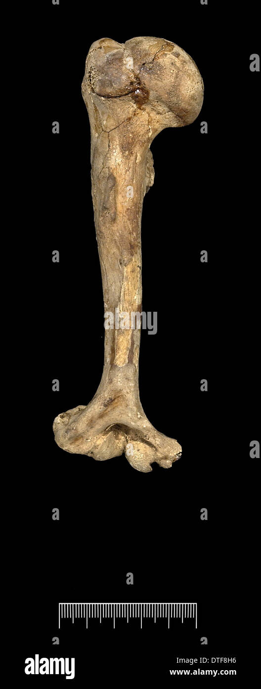 Humerus of Achondroplastic Dwarf Stock Photo - Alamy
