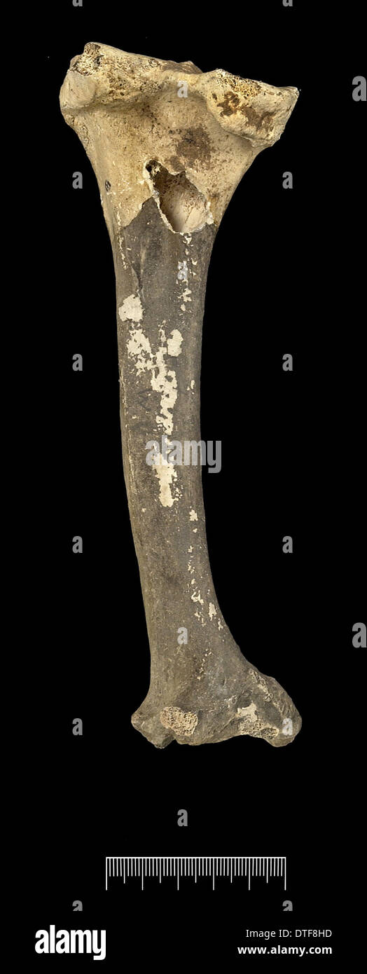 Tibia of Achondroplastic Dwarf Stock Photo - Alamy
