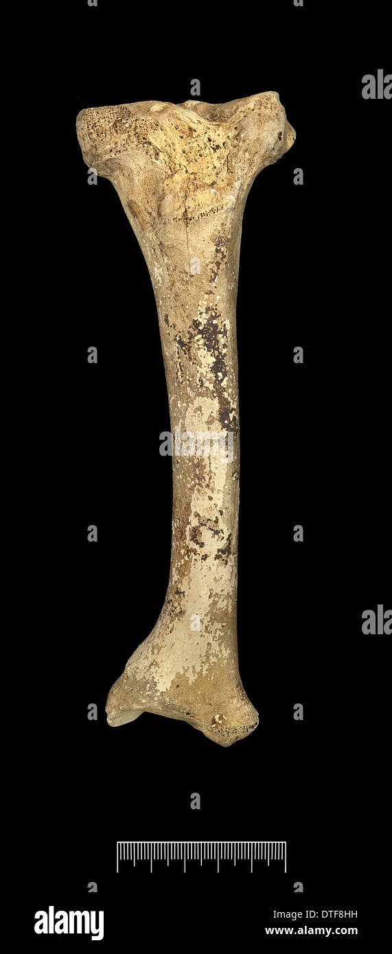 Tibia of Achondroplastic Dwarf Stock Photo - Alamy