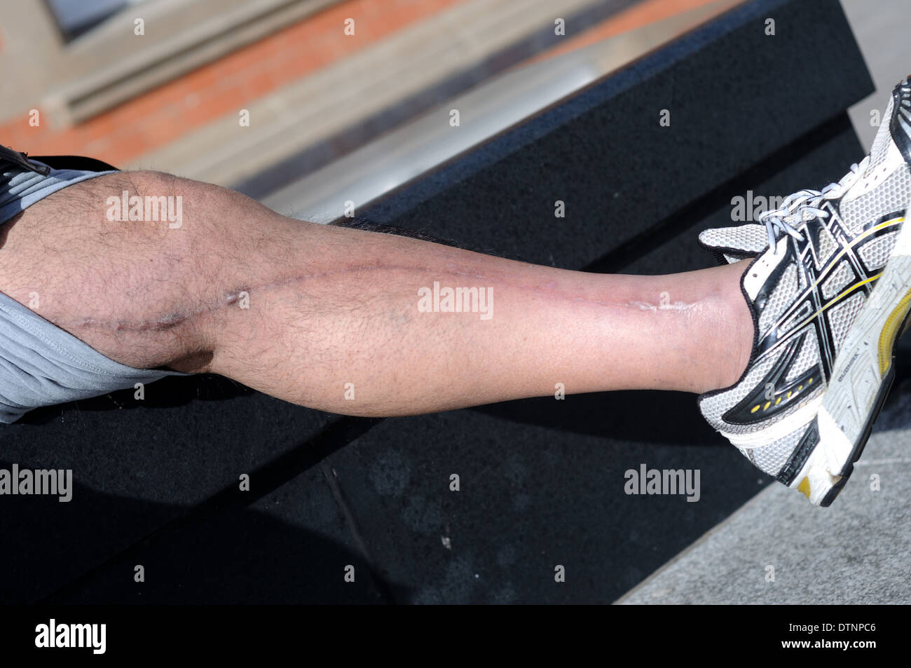 Heart Bypass Stock Photos & Heart Bypass Stock Images - Alamy