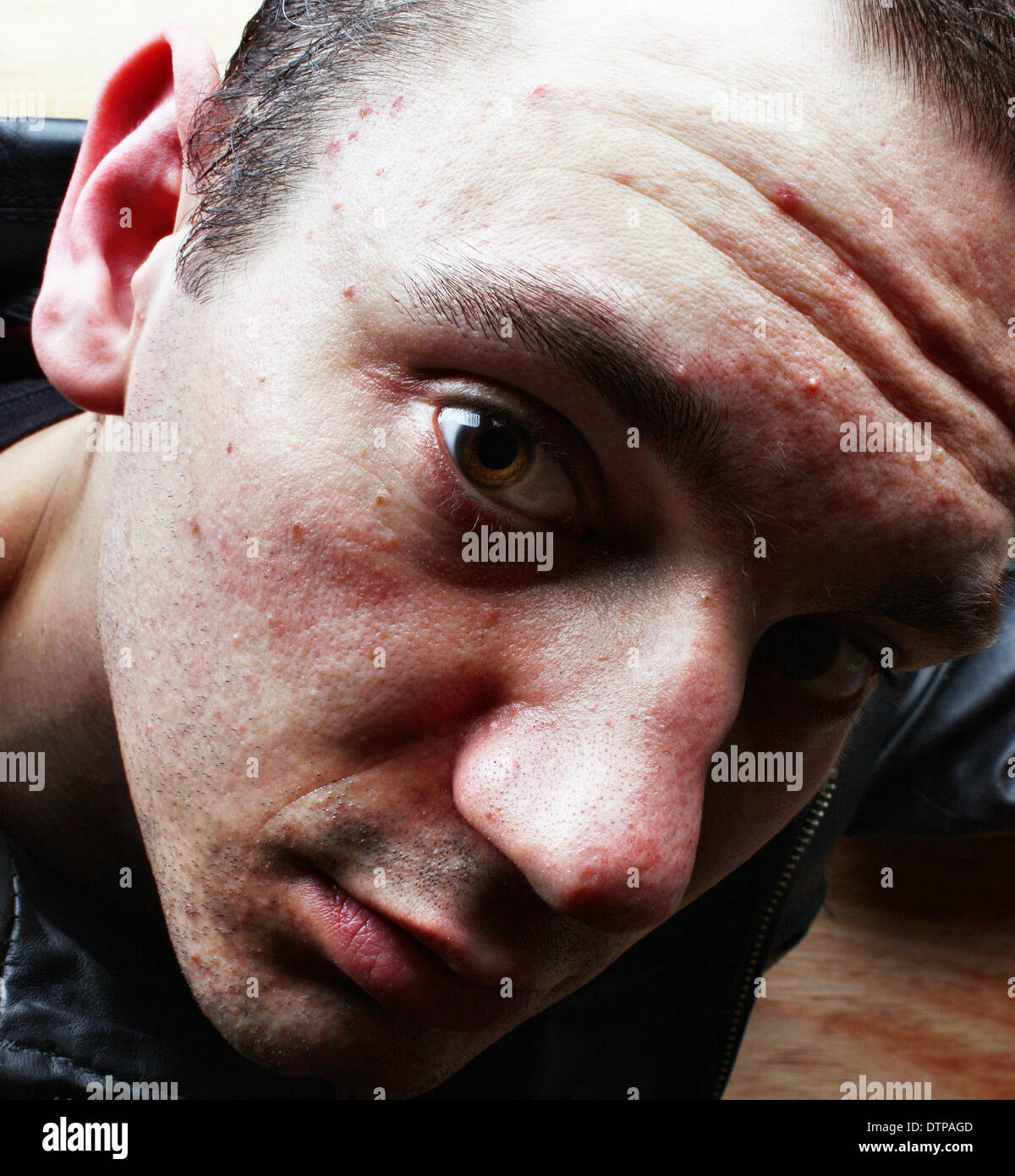 Acne pimples on the face of a young man Stock Photo - Alamy