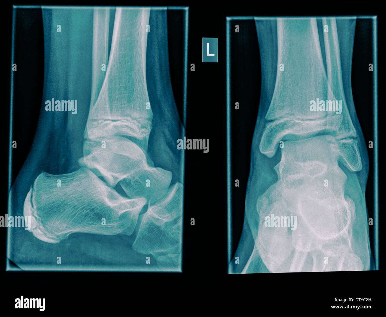 Healthy X-ray of an ankle 12 year old male Stock Photo - Alamy