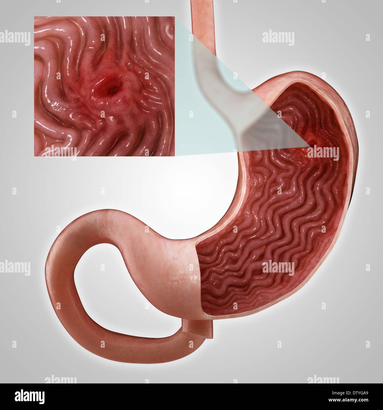 Gastric ulcer hi-res stock photography and images - Alamy