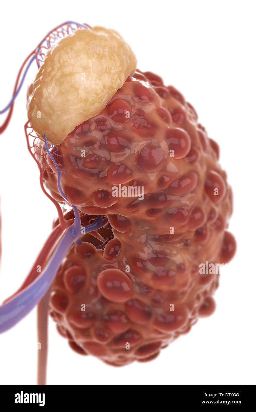 Kidney problem Cut Out Stock Images & Pictures - Alamy