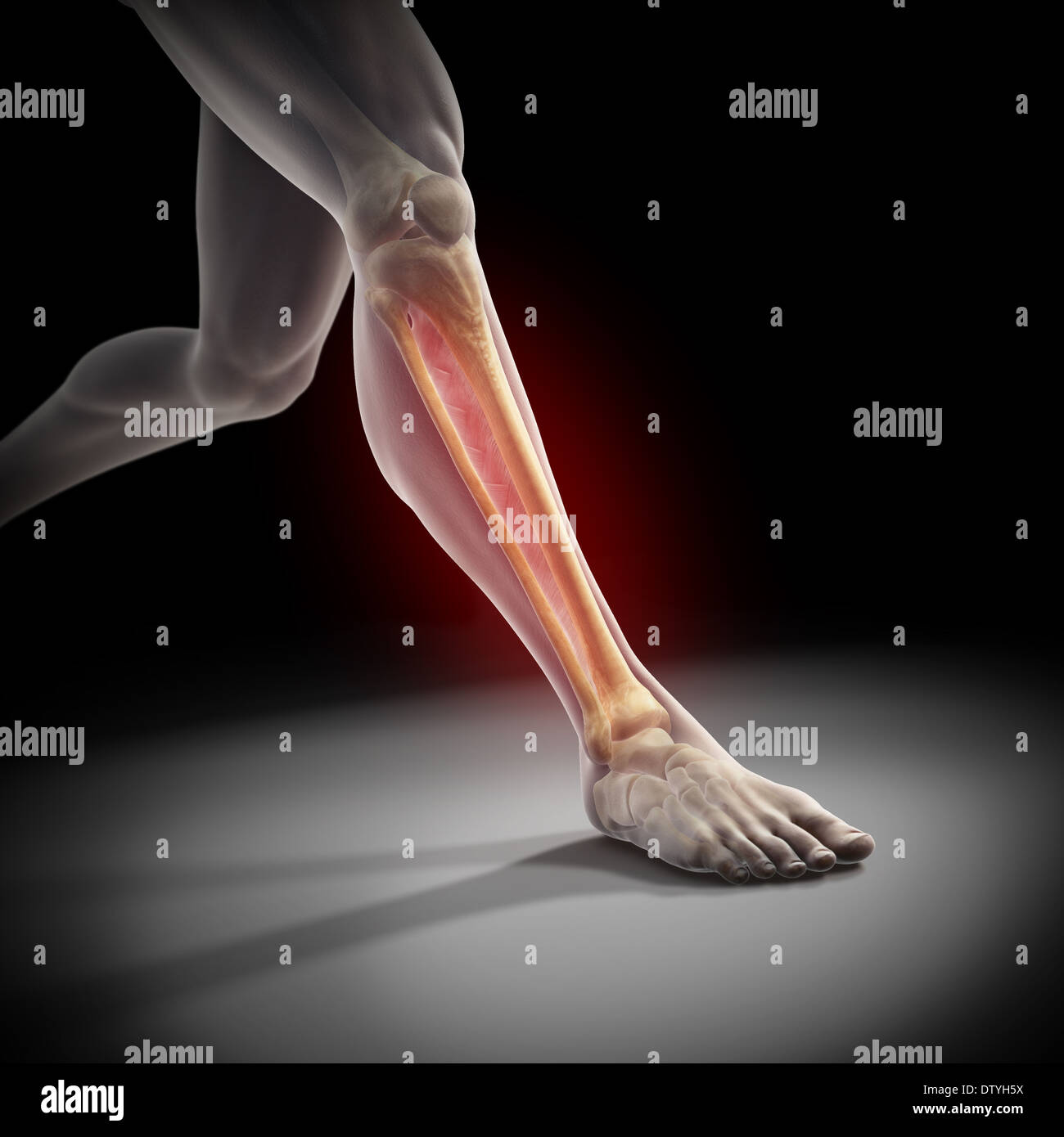Medial Tibial Stress Syndrome Shin Splints (Medial Tibial Stress