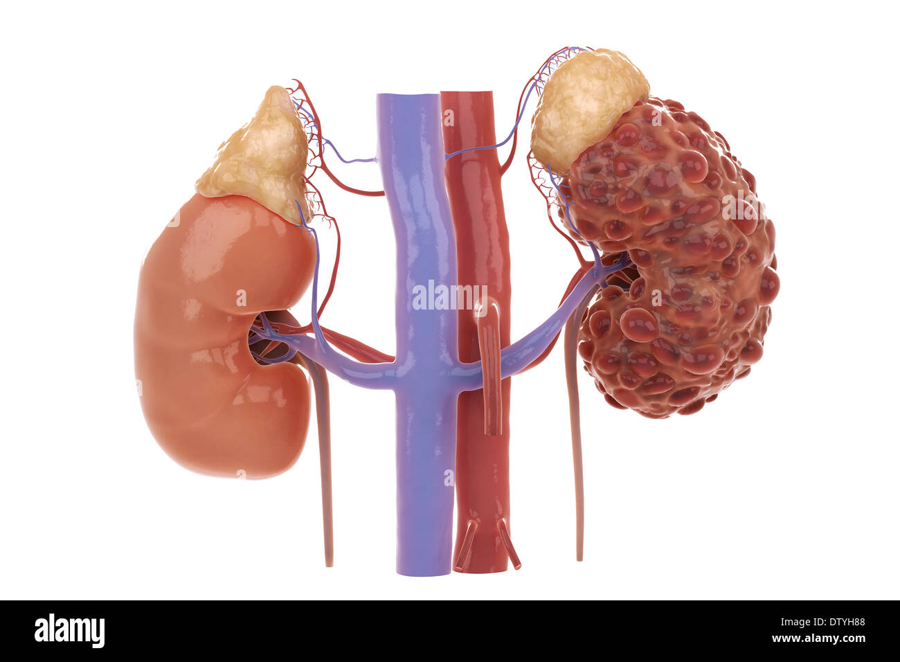 Polycystic kidney disease hi-res stock photography and images - Alamy