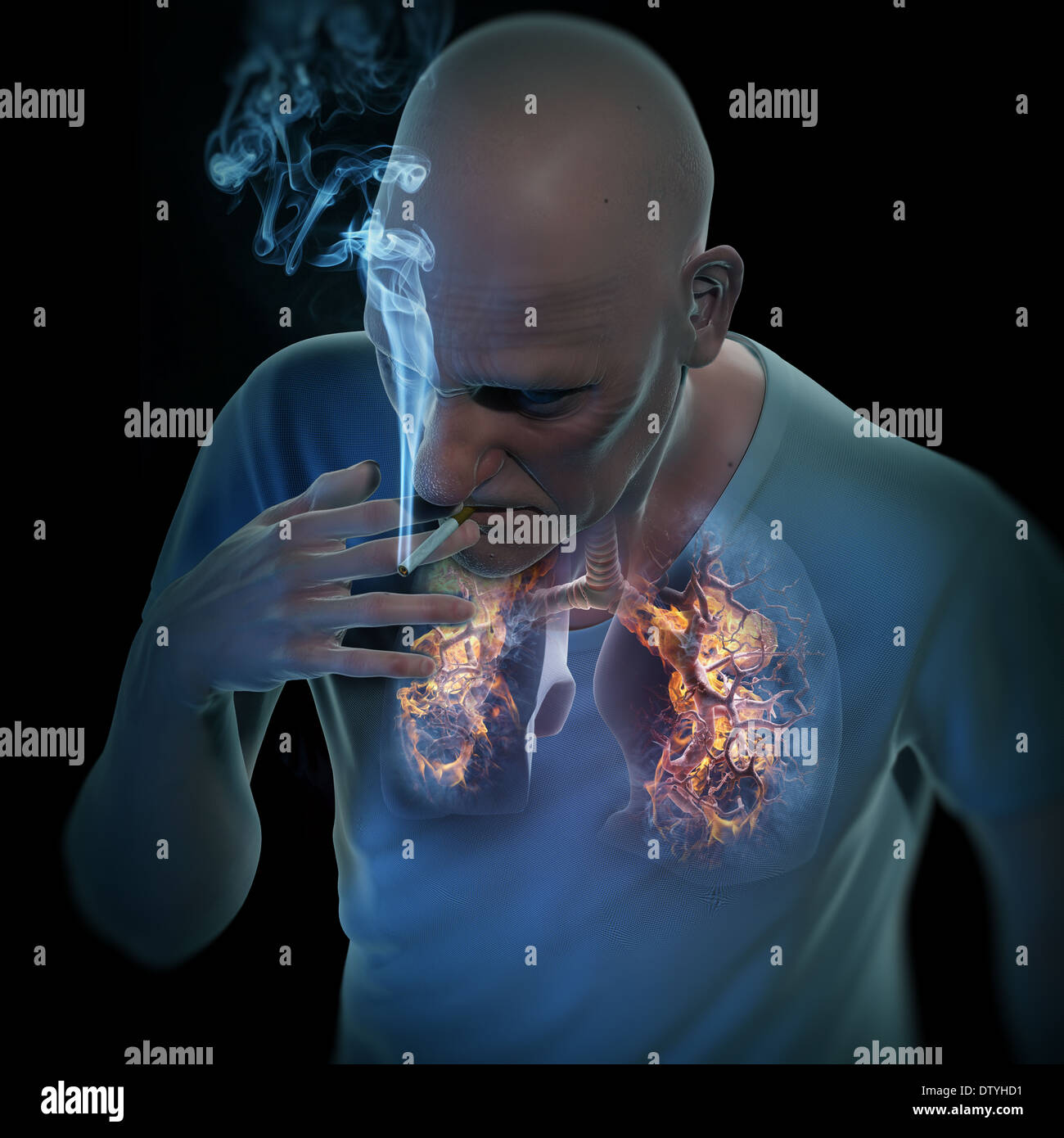 Trachea damage hi-res stock photography and images - Alamy