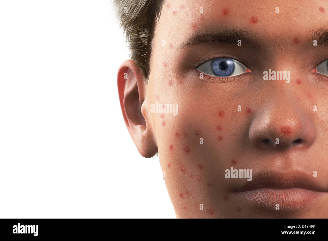 Varicella blisters hi-res stock photography and images - Alamy
