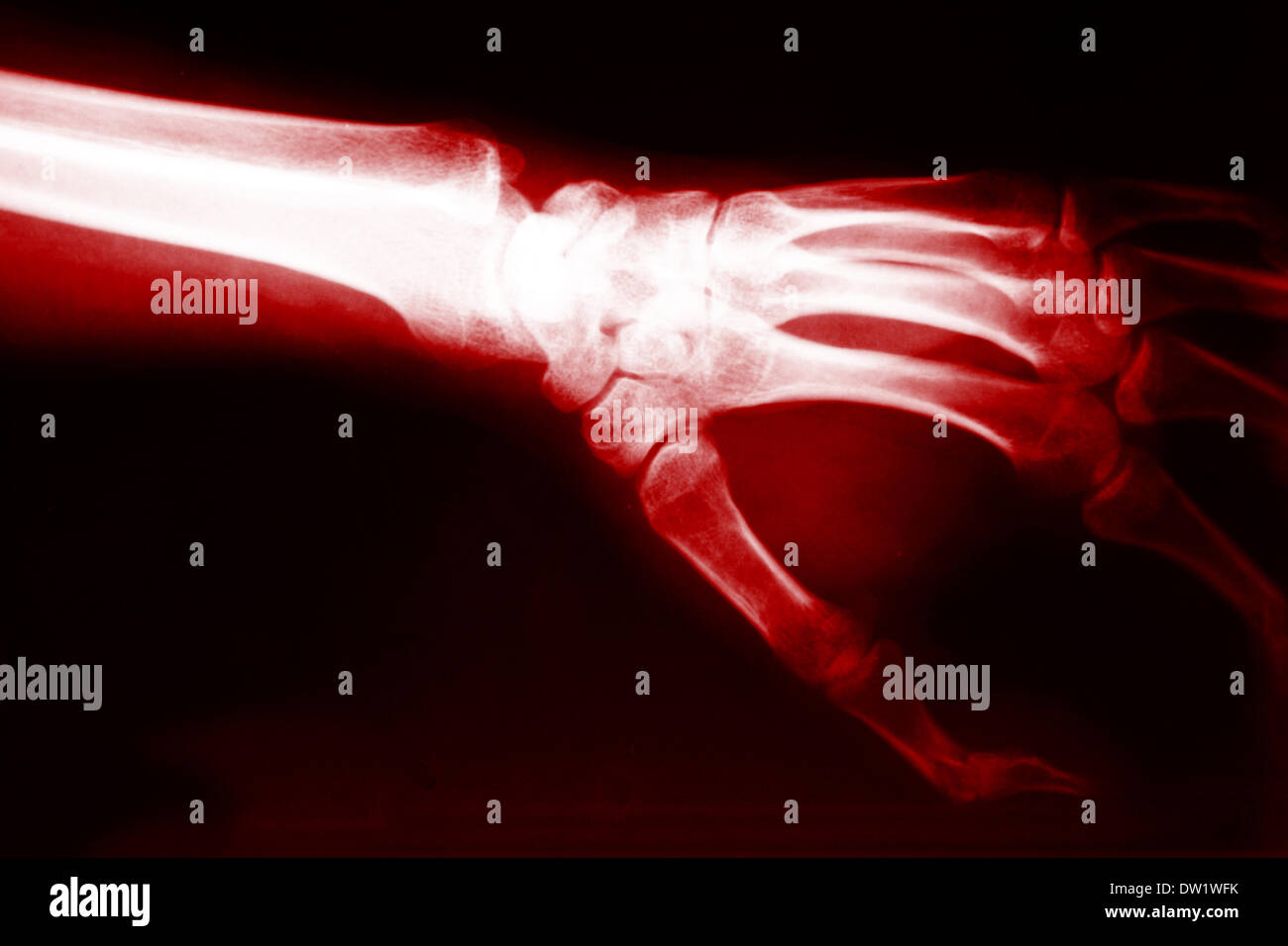 Broken Hand X Ray High Resolution Stock Photography and Images - Alamy