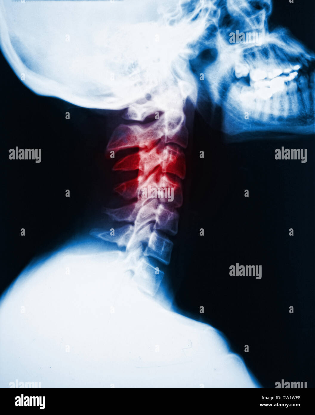 neck x-ray and pain Stock Photo - Alamy