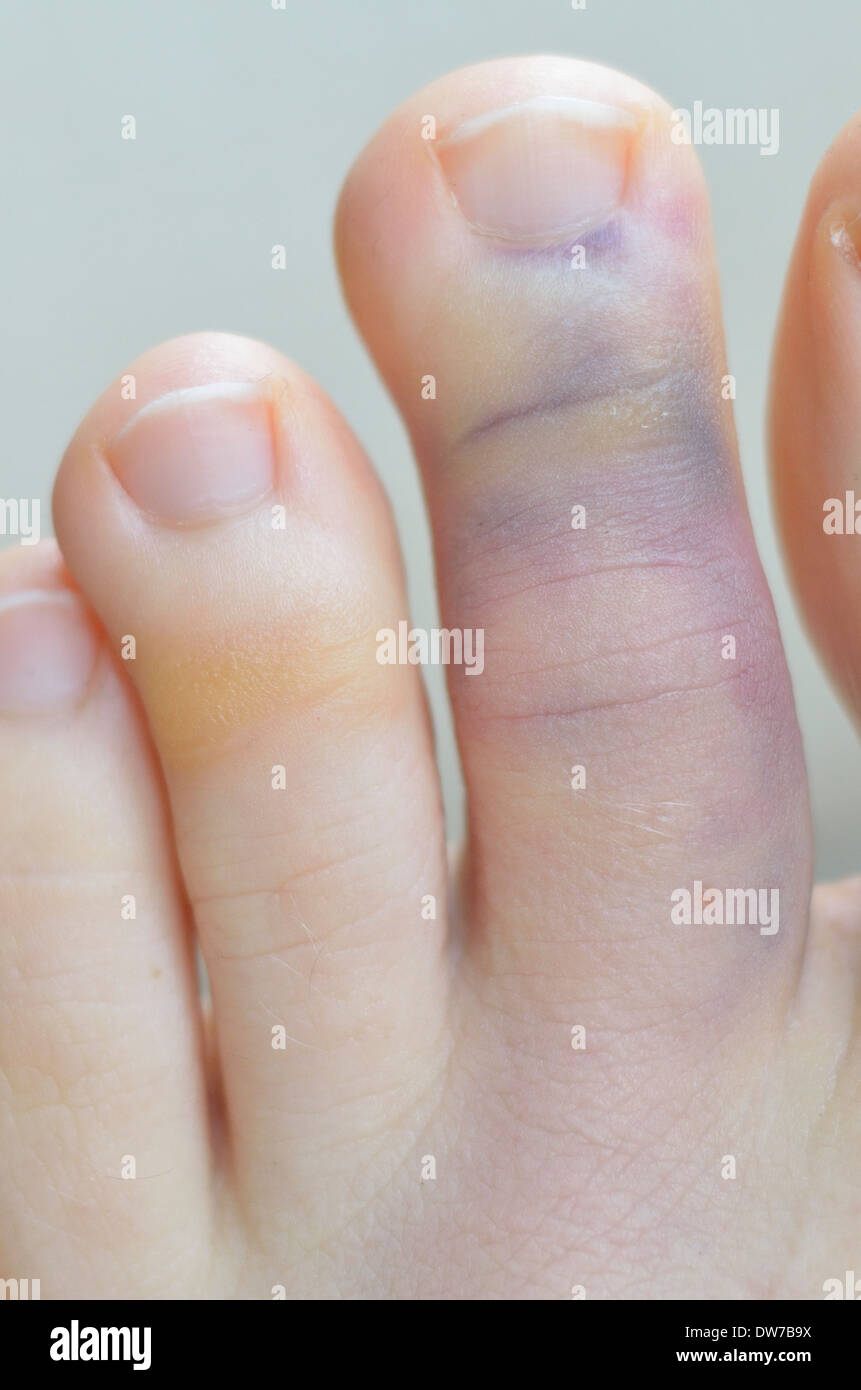 Bruised toe hi-res stock photography and images - Alamy
