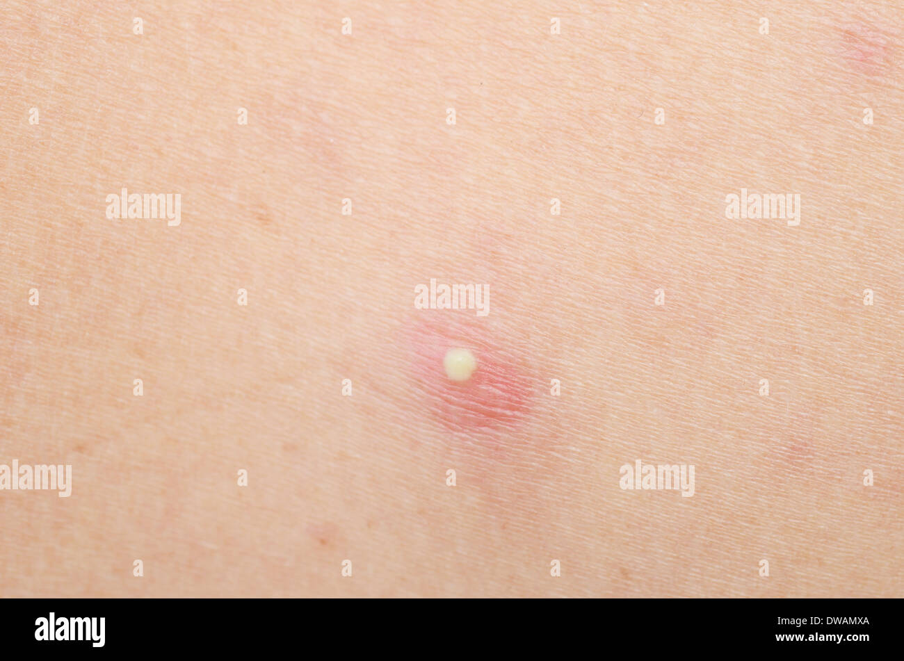Skin abscess hi-res stock photography and images - Alamy